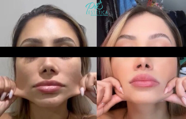 Endolaser - Papada - 1 Sessão - Pró Estética